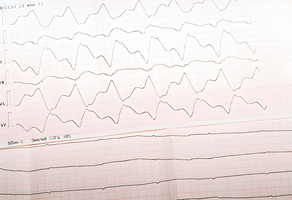 Asystole: Causes, Treatment, ECG, and Definition Overview