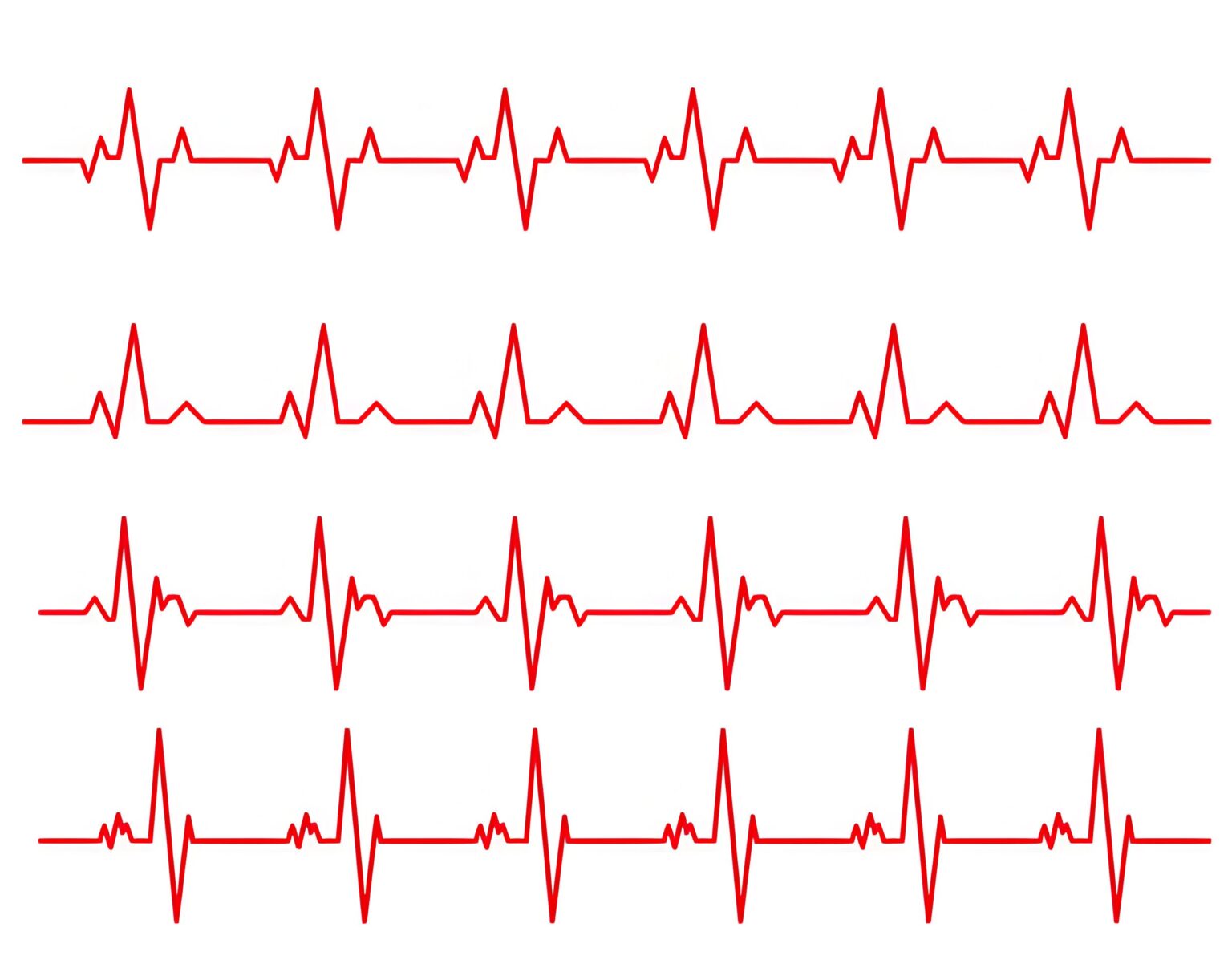 Monomorphic & Polymorphic Ventricular Tachycardias